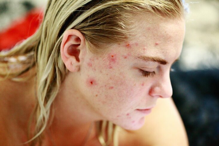 Natural Skin Care for Acne | Welcome to The Neuro Nerd!